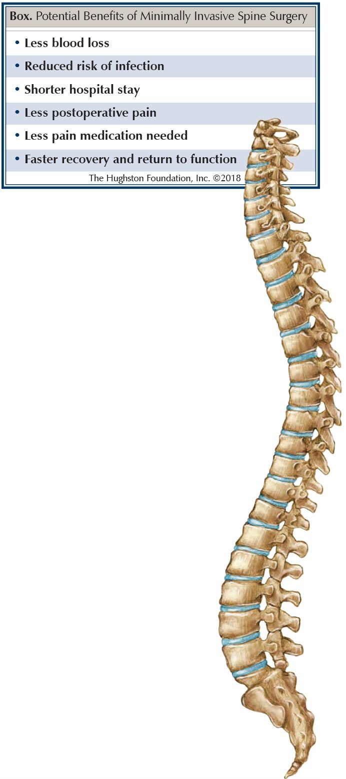 Minimally Invasive Spinal Surgery: At a Glance - Alabama